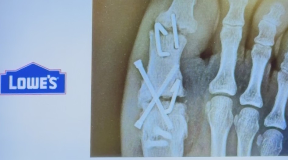 Hardware-Free Foot Surgery | Hoffman Estates Podiatrist