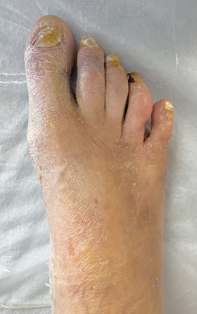 Minimal incision Tailor's Bunion without any internal hardware. Faster ...